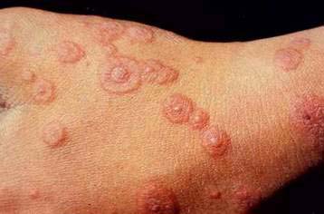 Doctors Gates: Erythema Multiforme Pic