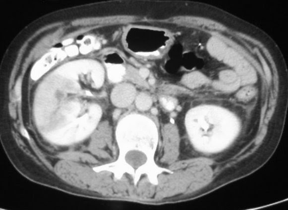ON - RADIOLOGY: CT of Acute Pyelonephritis