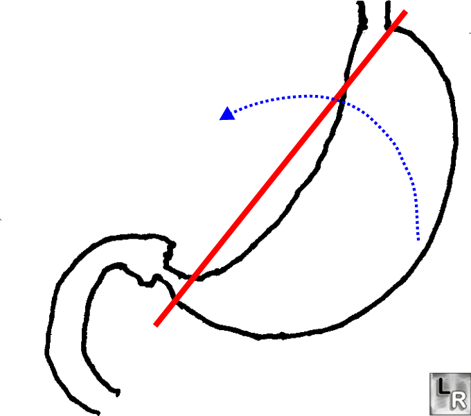 ON - RADIOLOGY: Gastric Volvulus and X-Ray