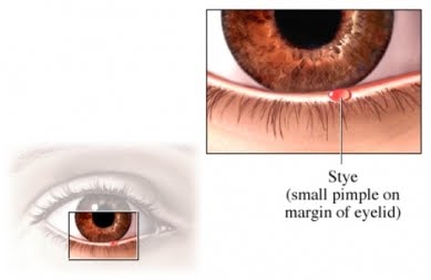 Doctors Gates: HORDEOLUM