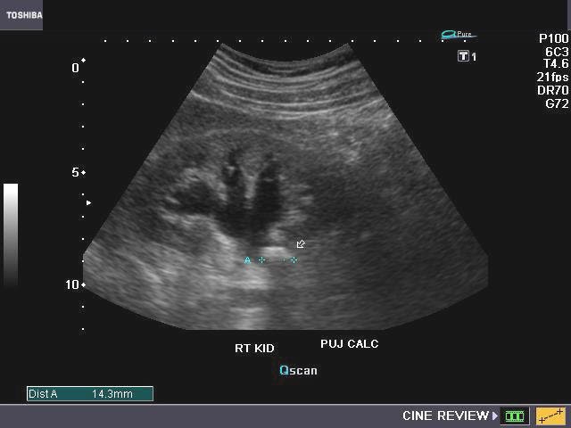 ON - RADIOLOGY: Pelvi-ureteric junction calculus (Toshiba Nemio-XG ...