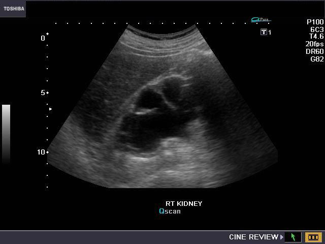 Doctors Gates: Grades of hydronephrosis (on Ultrasound imaging):