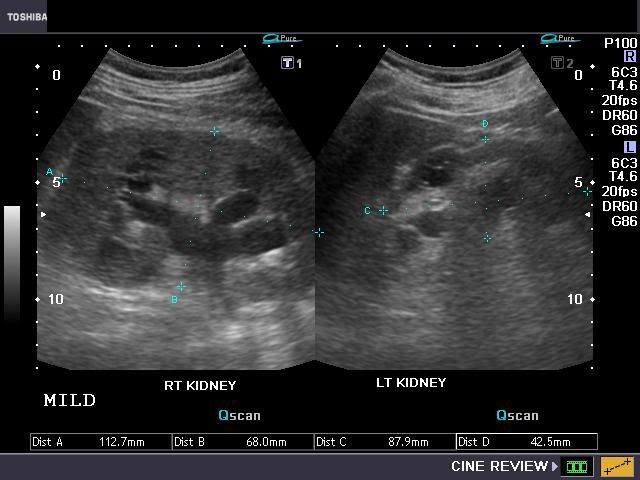 ON - RADIOLOGY: Grades of hydronephrosis (on Ultrasound imaging):