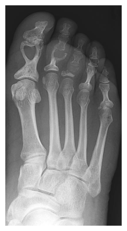 ON - RADIOLOGY: Sarcoid Arthropathy