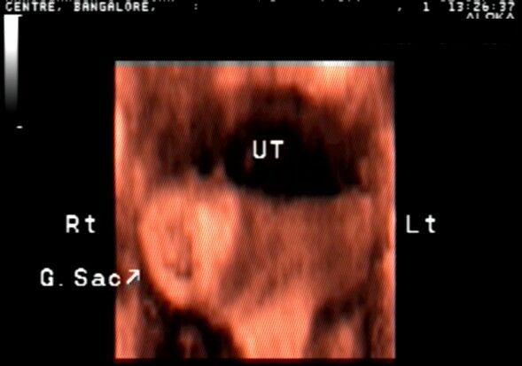 ON - RADIOLOGY: Cornual pregnancy