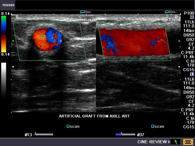 Doctors Gates: Axillofemoral bypass graft