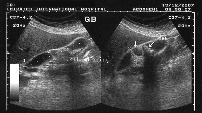 ON - RADIOLOGY: Adenomyomatosis of gall bladder-Segmental type