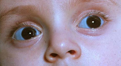 Doctors Gates: Osteogenesis imperfecta and it`s subtypes