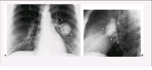 ON - RADIOLOGY: Tuberculoma & Calcified tuberculoma