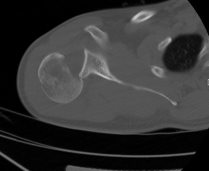 ON - RADIOLOGY: Posterior Shoulder Dislocation-3D CT