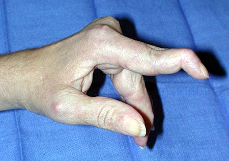 Doctors Gates: Swan-neck deformity