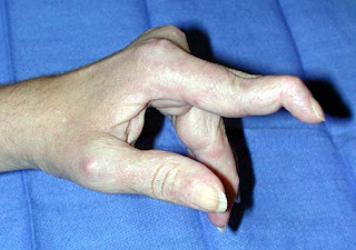 Doctors Gates: Swan-neck deformity