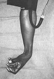 Doctors Gates: Trousseau sign of latent tetany