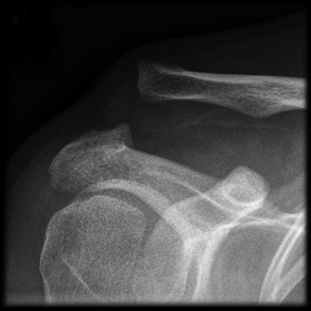 ON - RADIOLOGY: Allman and Tossy classification for Acromioclavicular ...