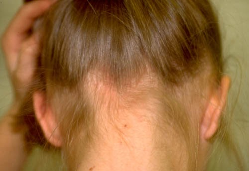 Medi Photos: About head lice infestations