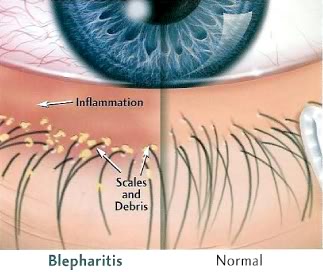 Doctors Gates: Squamous Blepharitis