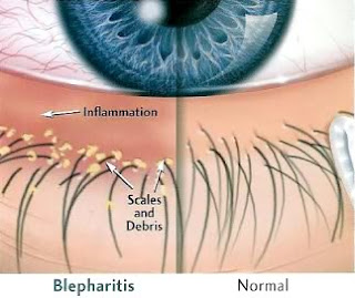 Doctors Gates: Squamous Blepharitis