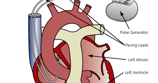 Doctors Gates: Cardiac Pacemaker