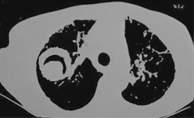 ON - RADIOLOGY: Chest x-ray --Air Crescent Sign