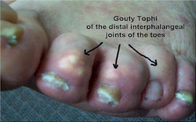 Doctors Gates: Chronic Gouty Tophi