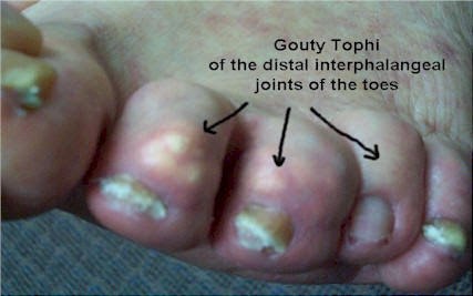 Doctors Gates: Chronic Gouty Tophi