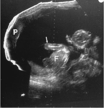 ON - RADIOLOGY: Idiopathic polyhydramnios