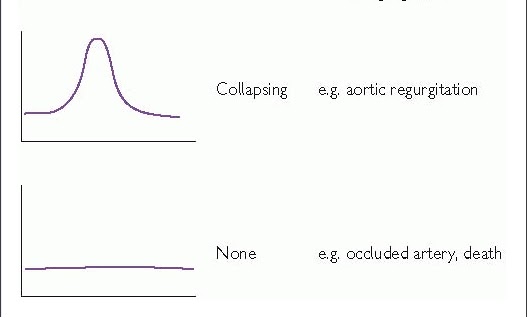 Doctors Gates: Different arterial pulse waveforms and example causes