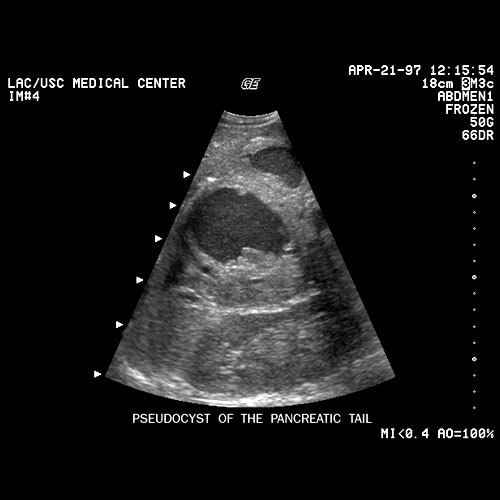 ON - RADIOLOGY: Pseudocyst formation in Acute Pancreatitis