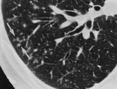 ON - RADIOLOGY: CT Sign of Tree-In-Bud Appearance