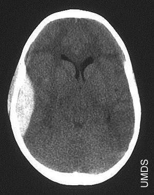 ON - RADIOLOGY: A brief introduction to Extradural haematoma in CT