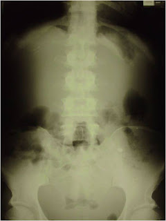 Nós sustentamos a ciência, e ela a nós: OCLUSÃO INTESTINAL