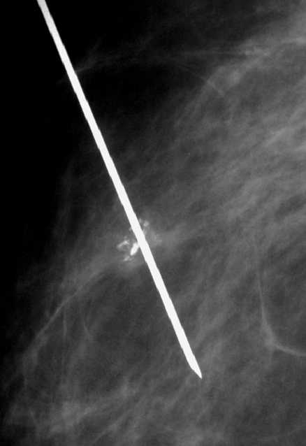 Oncopathology Update: Breast Core needle biopsy procedure