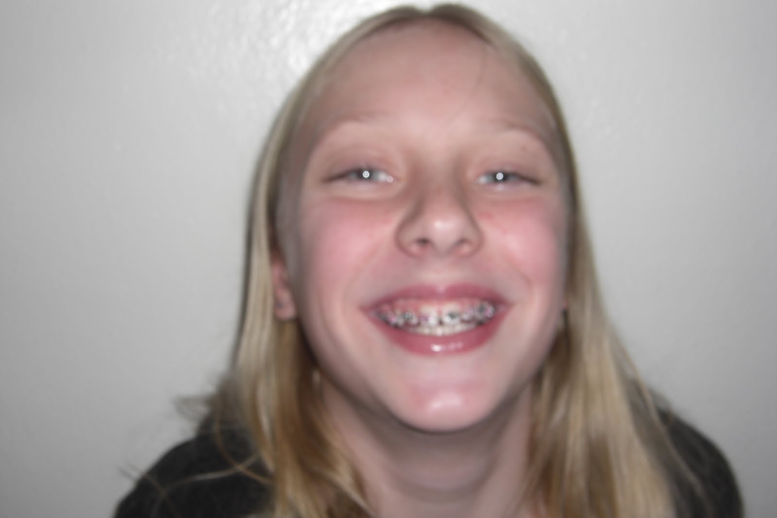 The Perkins Braces