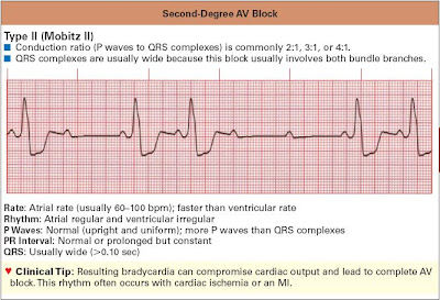 Medical Phase: Heart Block