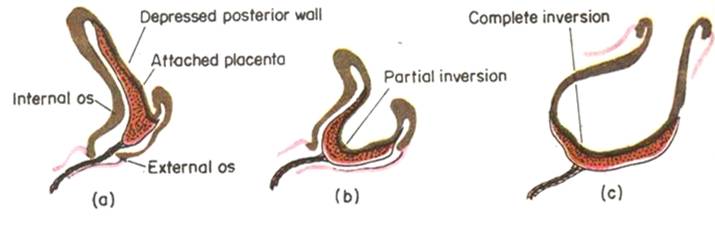 MEDICAL IMAGES: Degrees of inversion of uterus