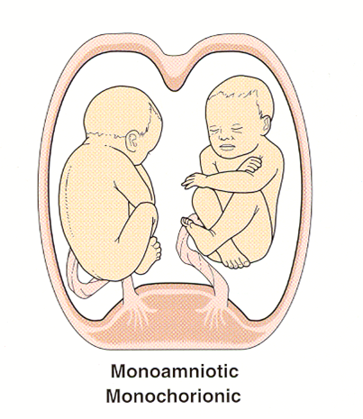 MEDICAL IMAGES: Monoamniotic monochorionic