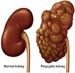 Aarthegreat: CONGENITAL CYSTIC KIDNEY