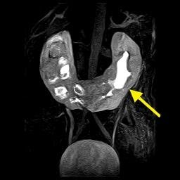 Renal Fellow Network: Horseshoe Kidney versus Crossed Fused Ectopia