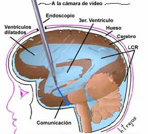 Neurocirugía Distrito Federal: Hidrocefalia