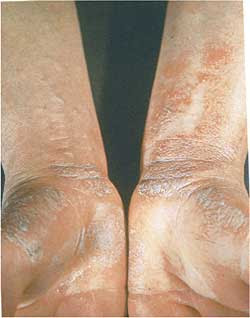 Healthy and Beauty Tips: Skin Burn Treatment | Burn Injury