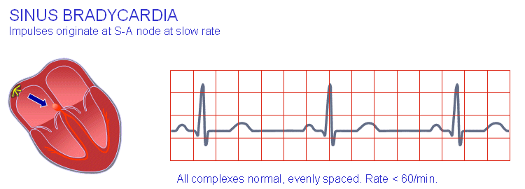 HumBiE: EKG : Sinus Bradycardia