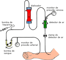 Doente Renal: Processo de Hemodiálise