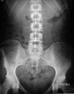 Frojon: Kidney Special