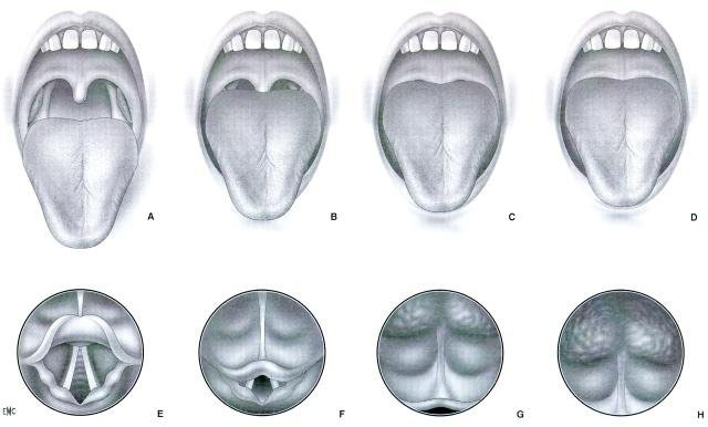 Taysir assistance الإسعاف الطبي تيسير: Classes de Mallampati