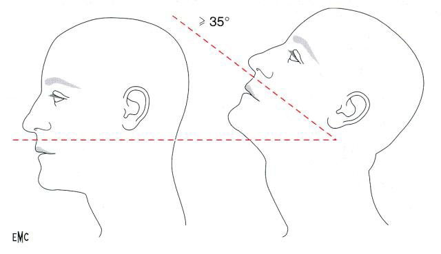 Taysir assistance الإسعاف الطبي تيسير: Angle de Bellhouse et Doré
