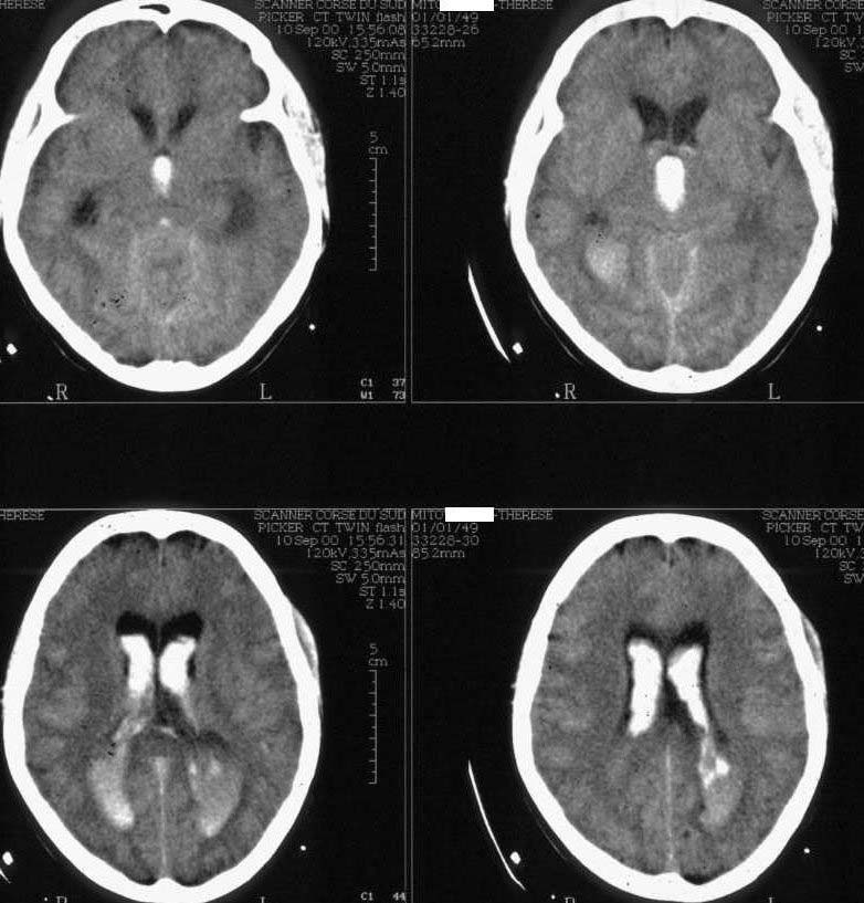 Taysir assistance الإسعاف الطبي تيسير: Hydrocéphalie aiguë sur ...
