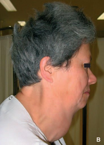 Taysir assistance الإسعاف الطبي تيسير: Volumineux goitre plongeant.