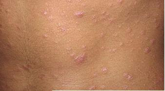 Ciência da Vida: Série DST: Síflis (cancro duro)