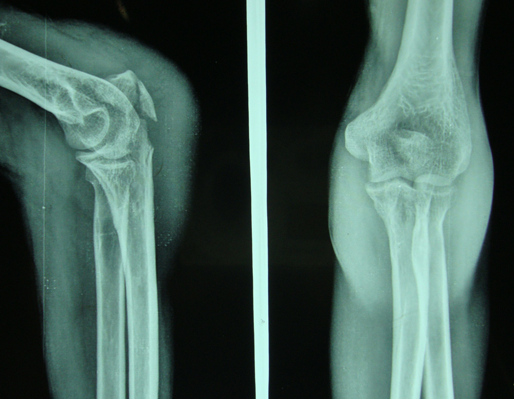 Trinity Orthopedics: Olecranon Fractures : Adults
