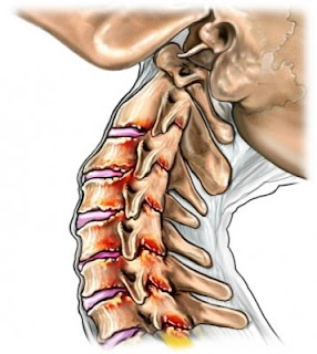 Definición y soluciones de los problemas de espalda: Torceduras de espalda